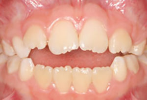Crooked Teeth and Common Types of Bite Misalignment Problems