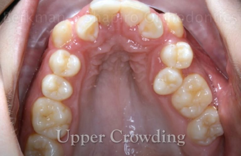 Crowded Teeth - Why It Happens & What to Do About It