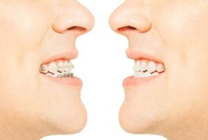 Jaw Alignment and Orthodontics - Importance of a Balanced Bite