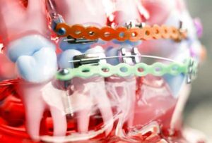 When Do You Get Power Chain Braces? A Comprehensive Guide