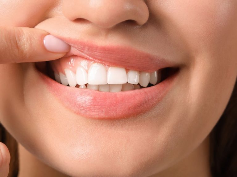Teeth After Braces: What to Expect & How to Care